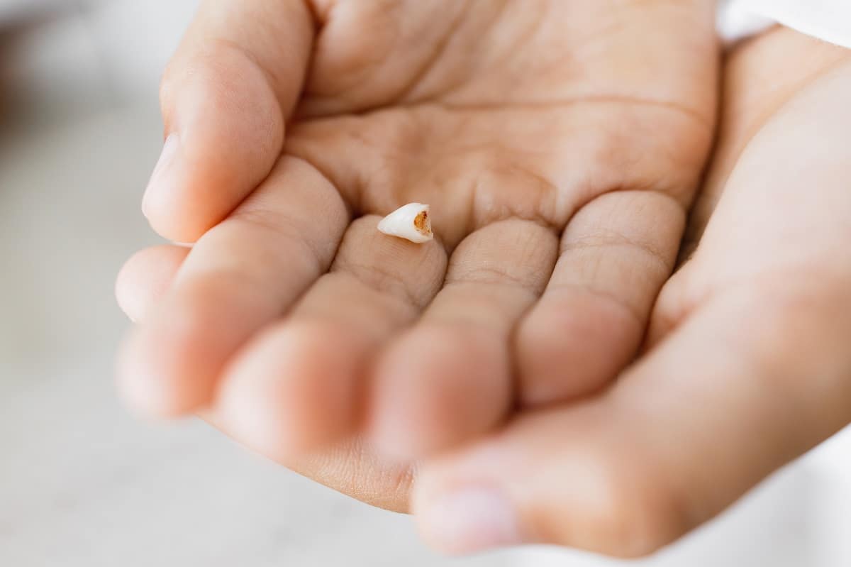 Can a Broken Tooth Be Fixed? Dentist Guide